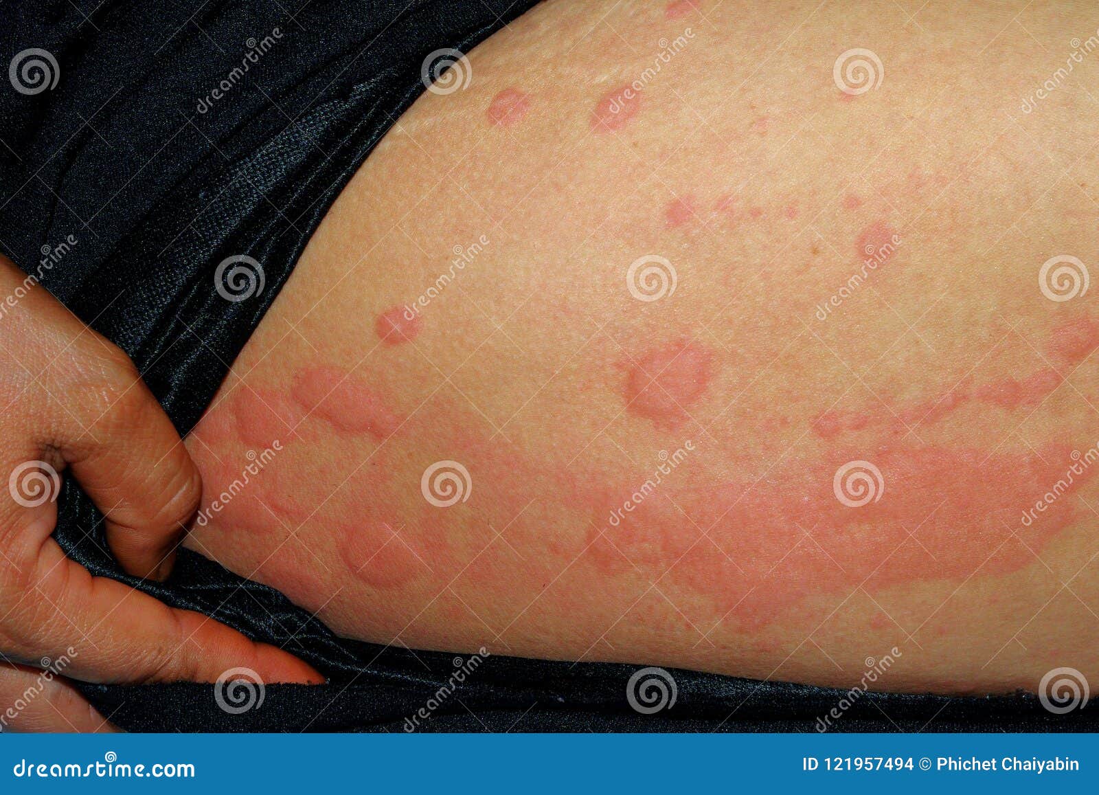 Prurido do Urticaria foto de stock. Imagem de fundo - 121957494