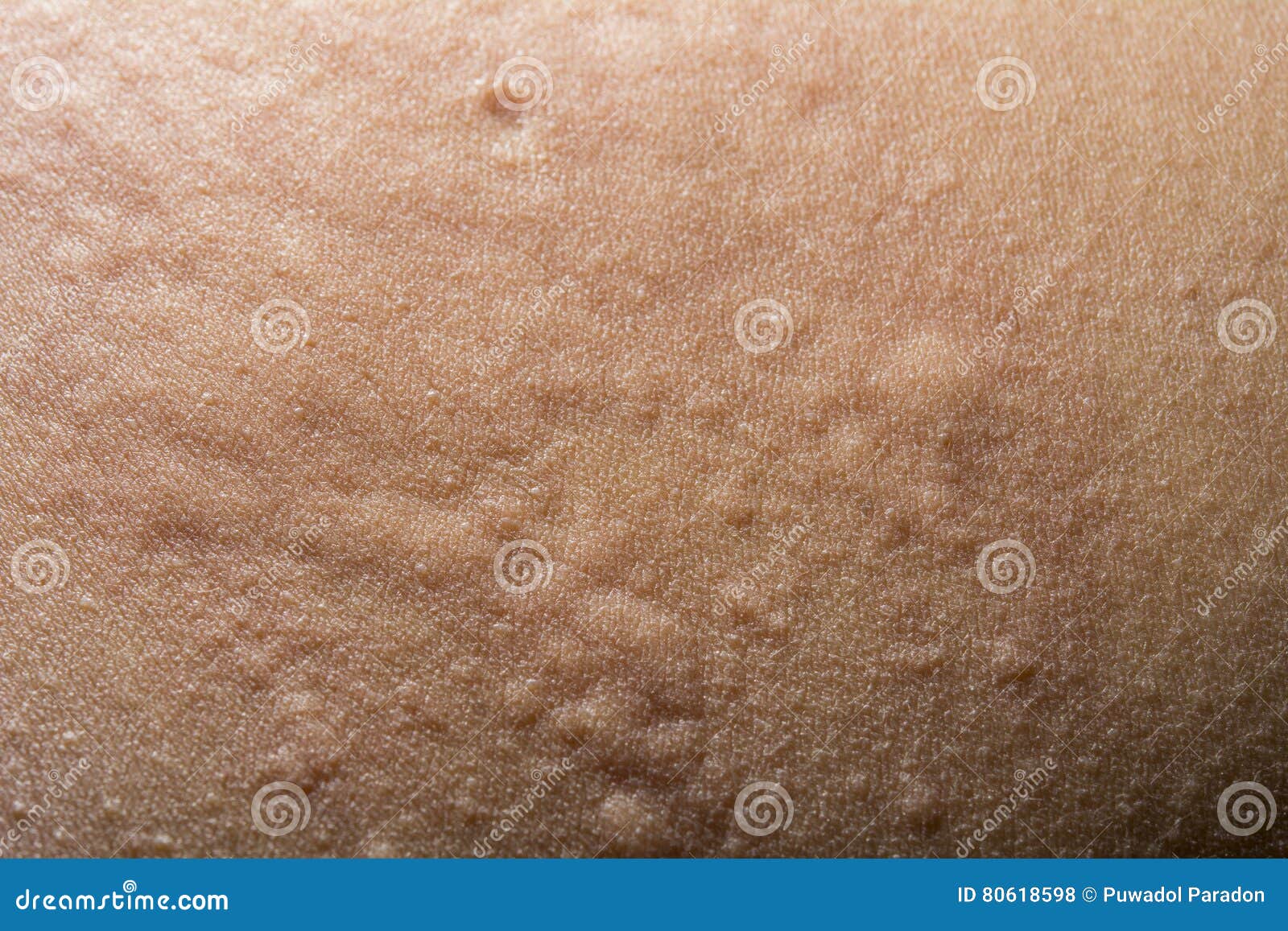 Prurido Do Urticaria Ou Da Alergia Foto de Stock - Imagem de pele ...
