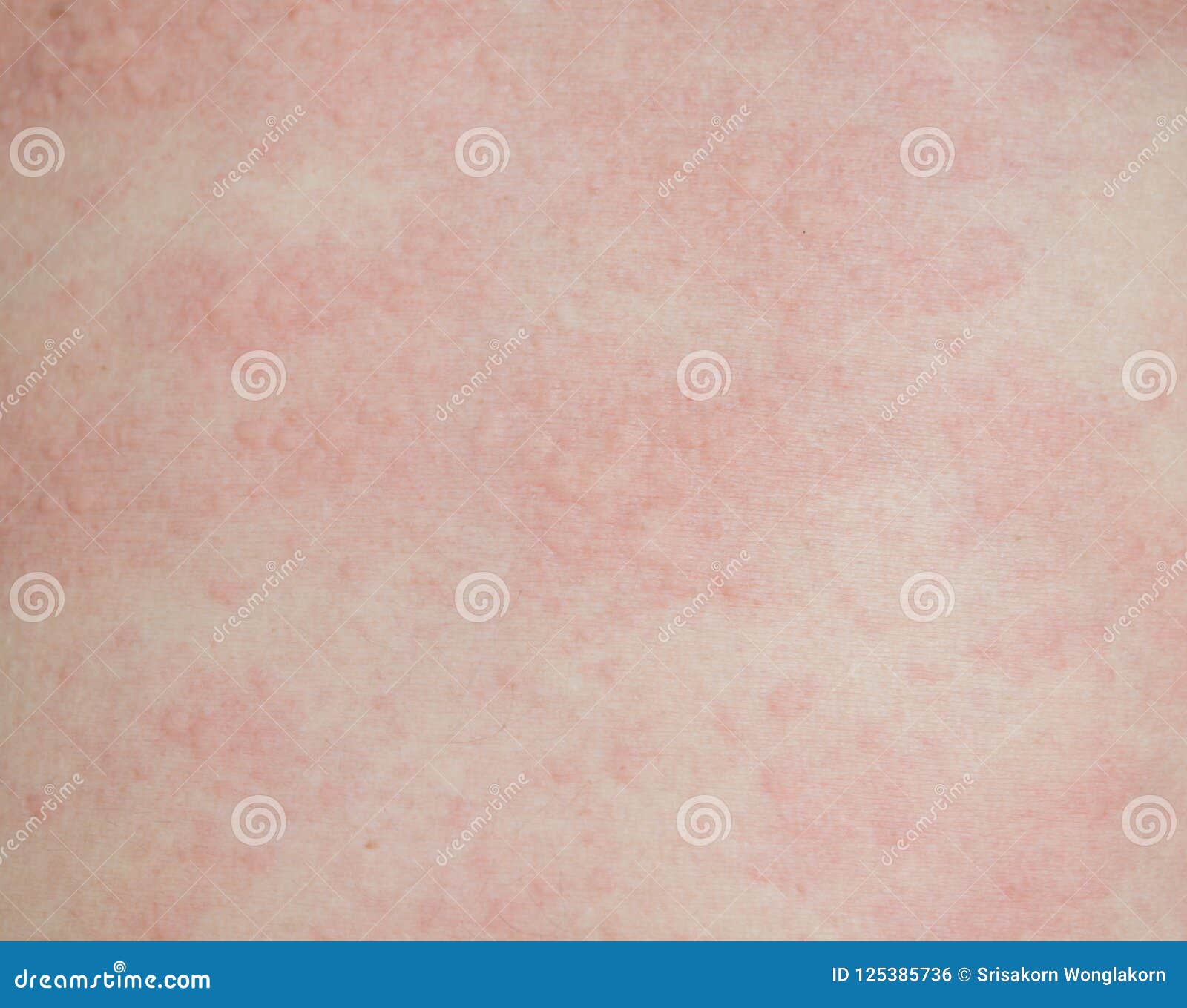 Prurido Em Problemas De Pele Do Corpo Foto de Stock - Imagem de detalhe ...