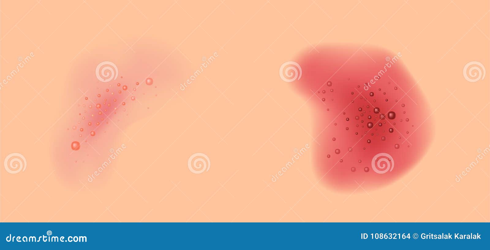 Prurido na pele ilustração do vetor. Ilustração de sintoma - 108632164