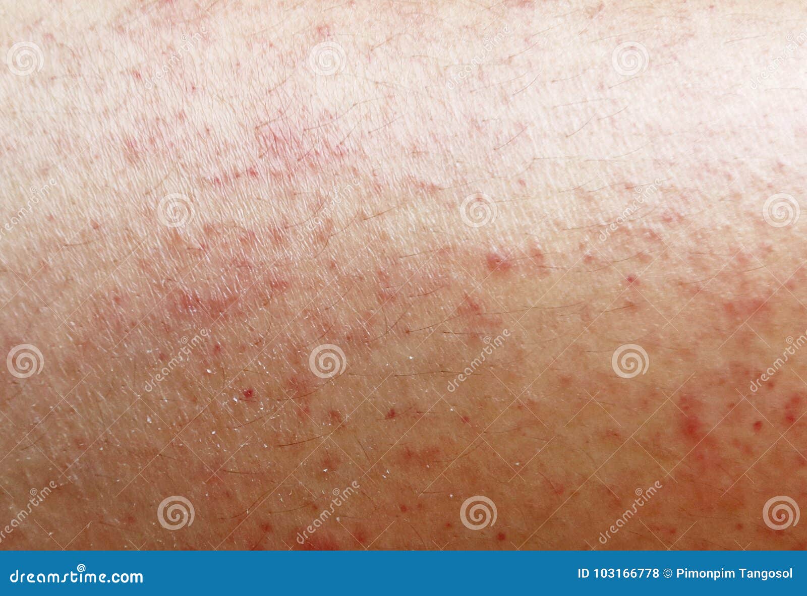 Prurido na pele sensível foto de stock. Imagem de cara - 103166778