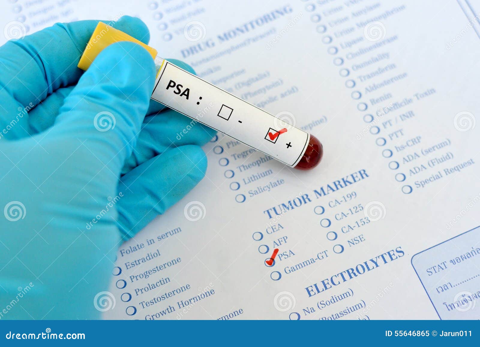 PSA positive stock image. Image of hematology, immunology - 55646865