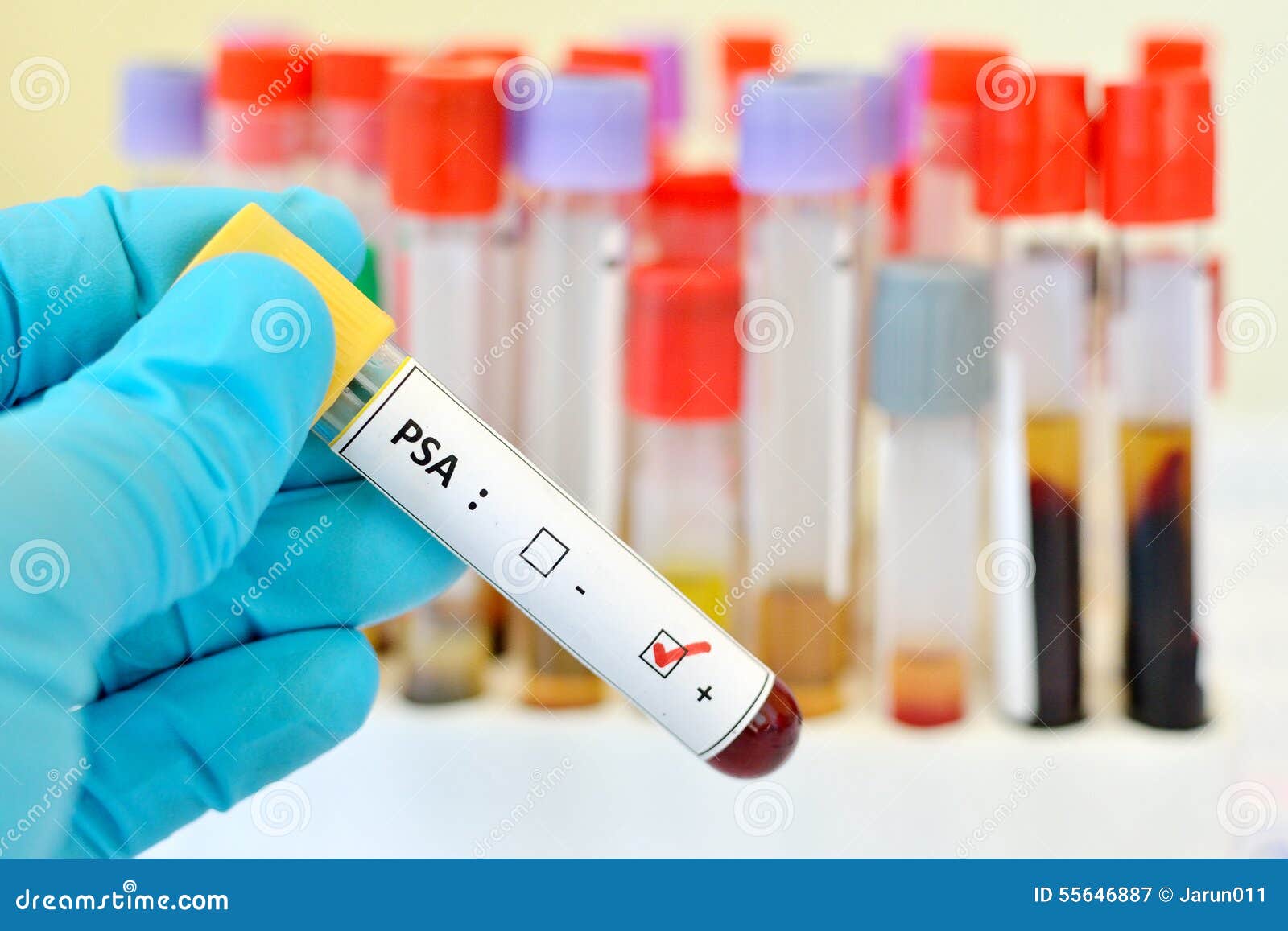 PSA positive stock image. Image of hospital, analyzing - 55646887