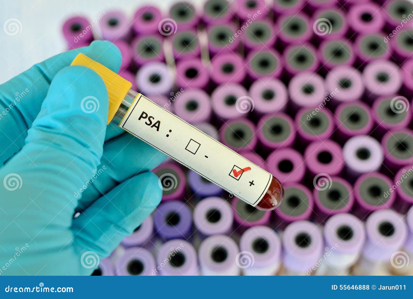 PSA positive stock photo. Image of tube, disease, hospital - 55646888