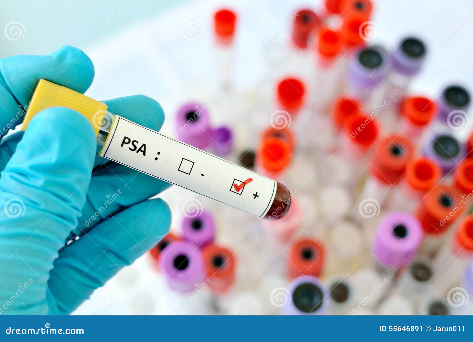 PSA positive stock image. Image of patient, prostate - 55646891