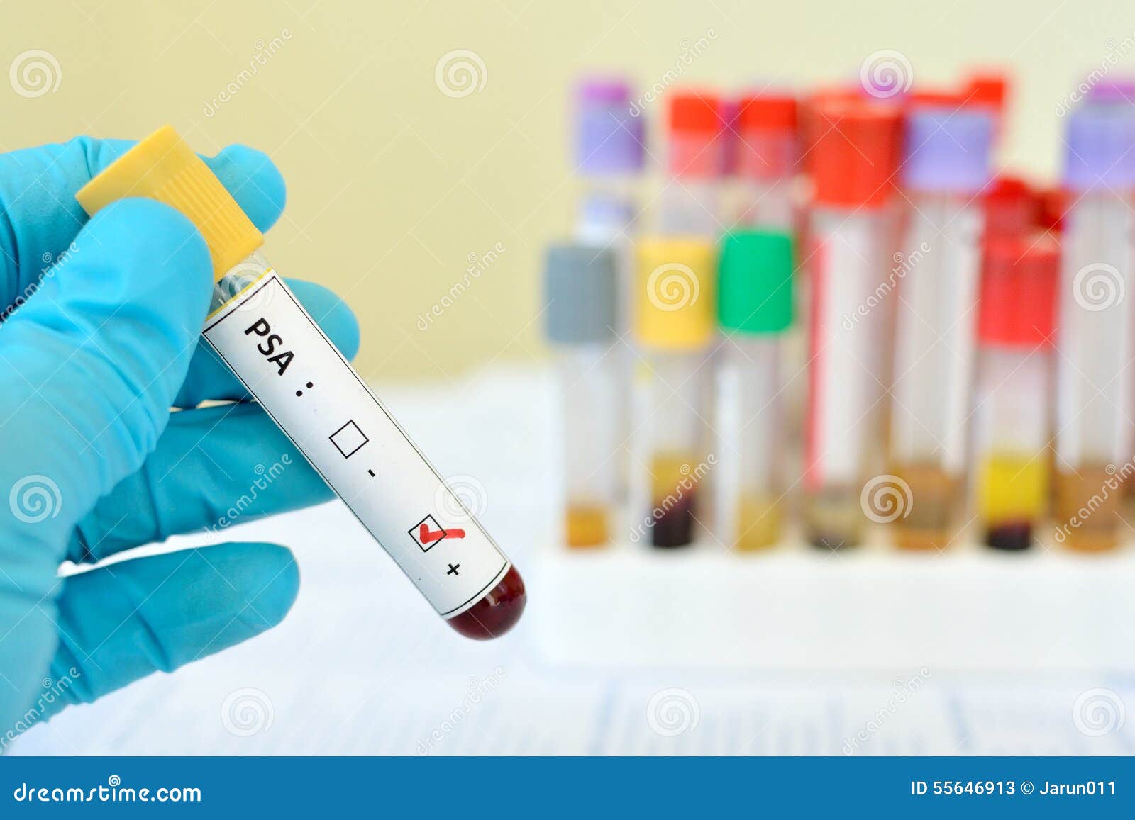 PSA positive stock image. Image of science, immunology - 55646913