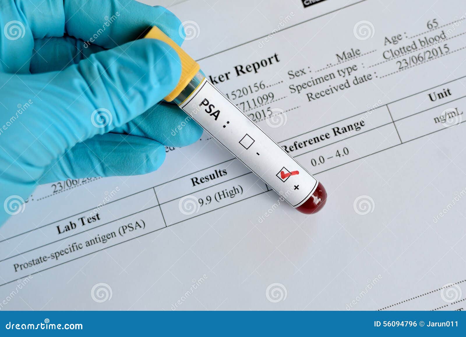 PSA positive stock photo. Image of sample, experiment - 56094796