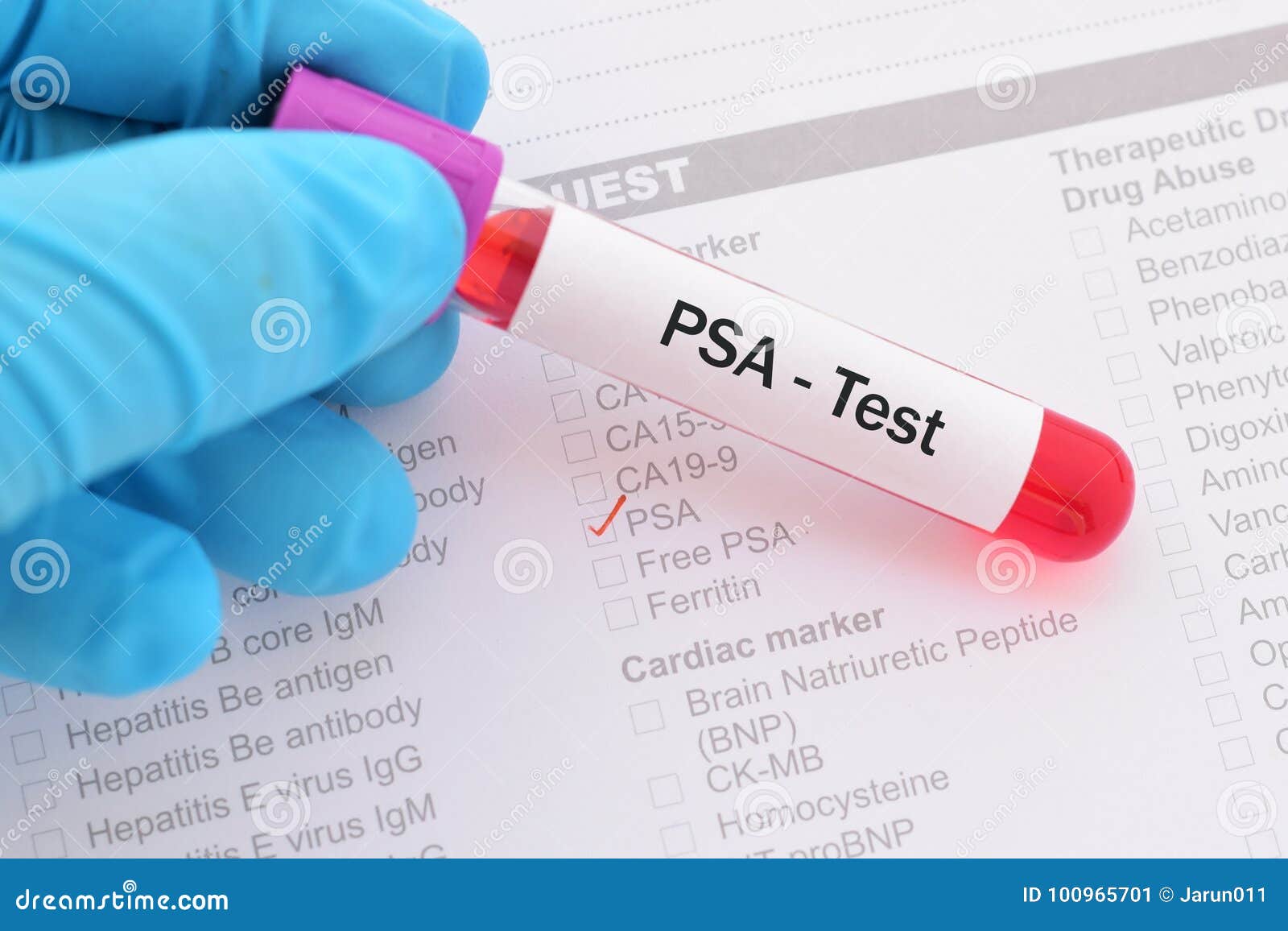 PSA Test stock afbeelding. Image of serologie, ziekenhuis - 100965701