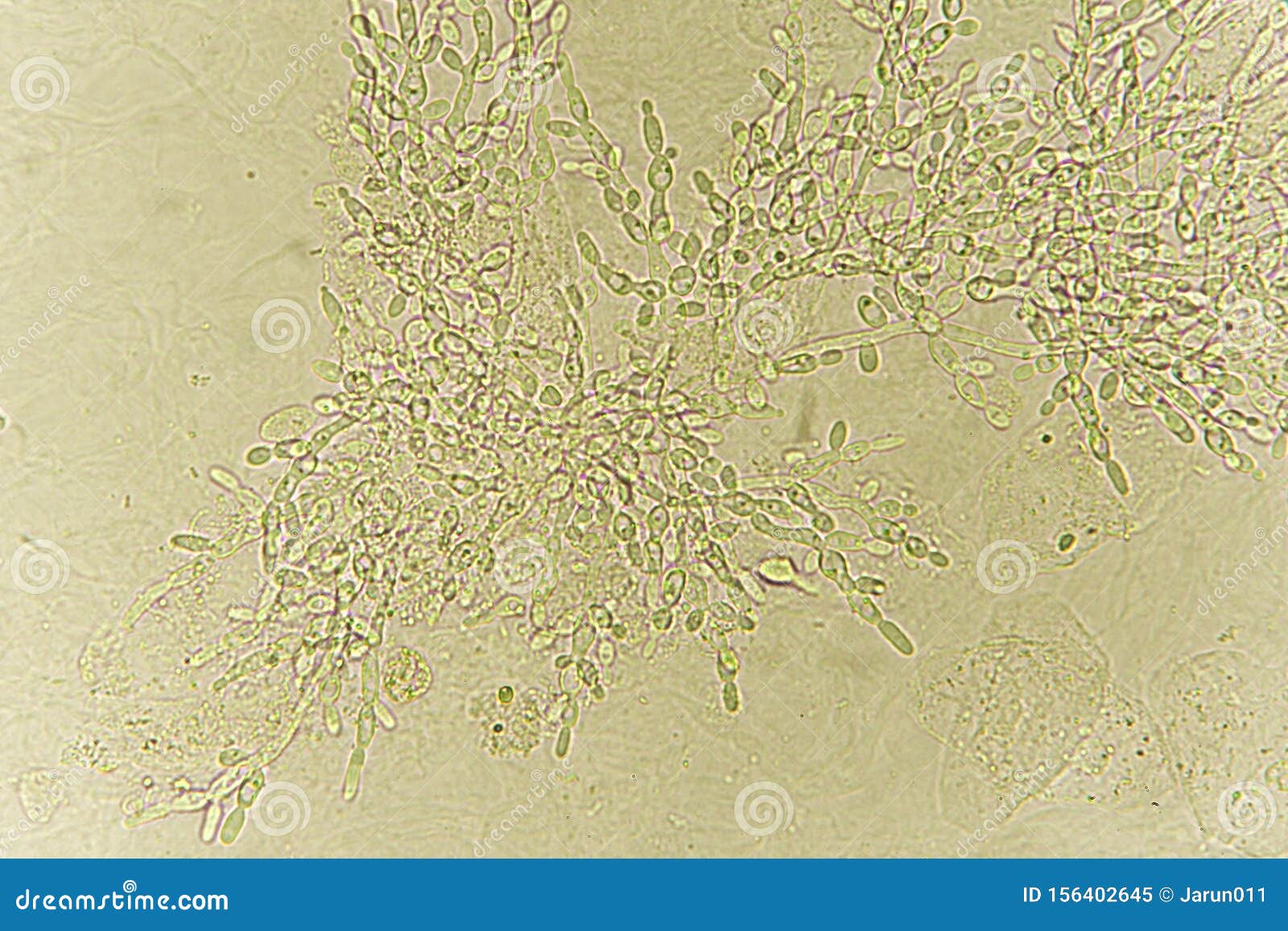 Pseudohyphae and Budding Yeast Cells in Patient Urine Stock Image ...