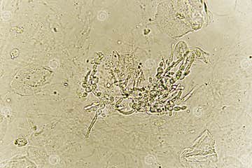 Pseudohyphae and Budding Yeast Cells in Patient Urine Stock Photo ...