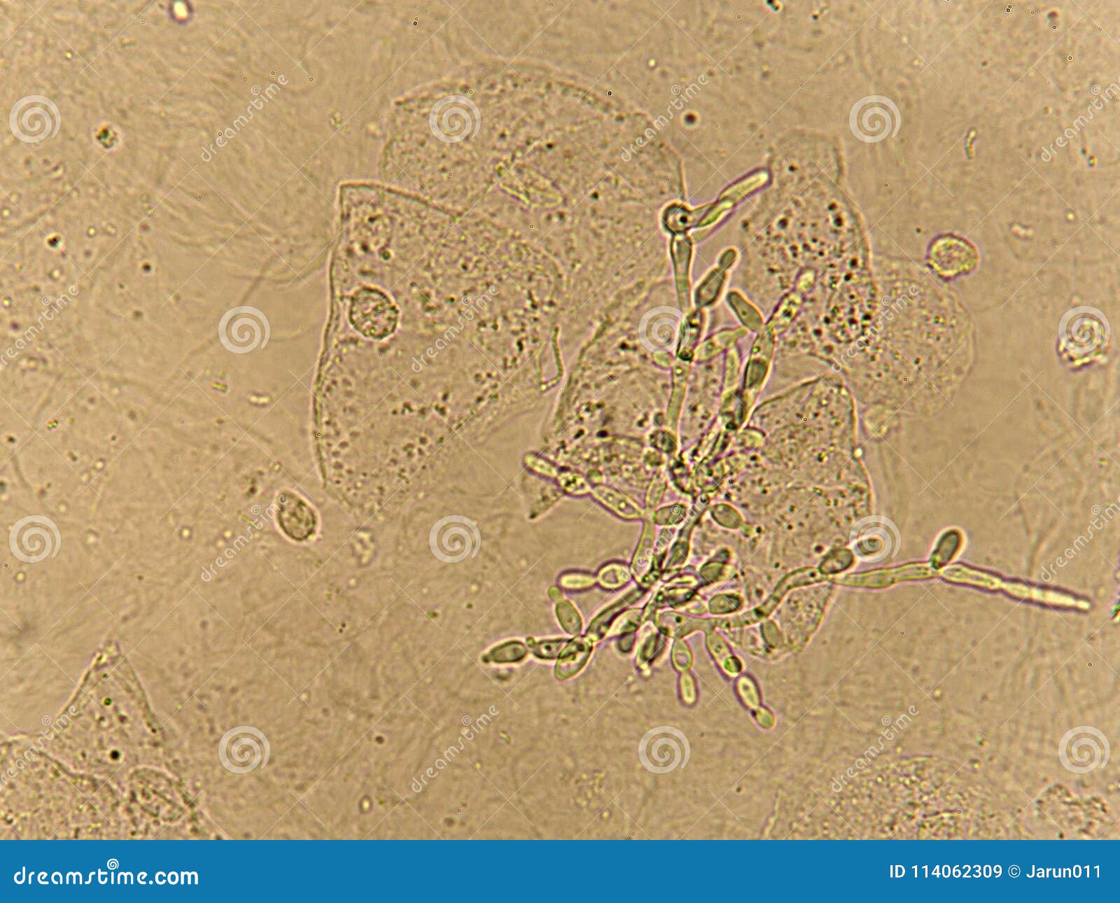 Candida Pseudohyphae