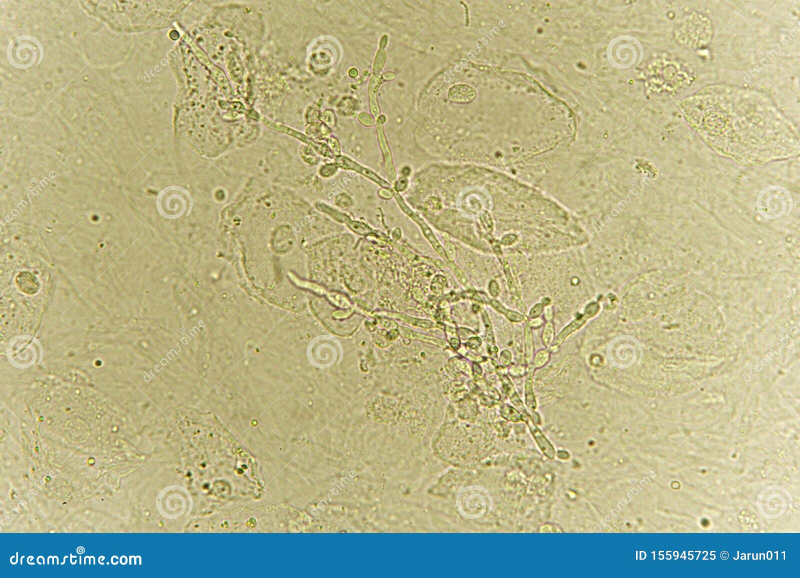 Pseudohyphae and Budding Yeast Cells in Patient Urine Stock Image ...