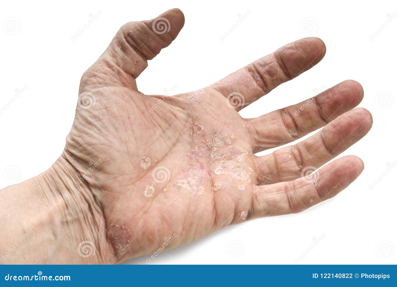 Psoriasi, Malattia Della Pelle Fotografia Stock - Immagine di prurito ...