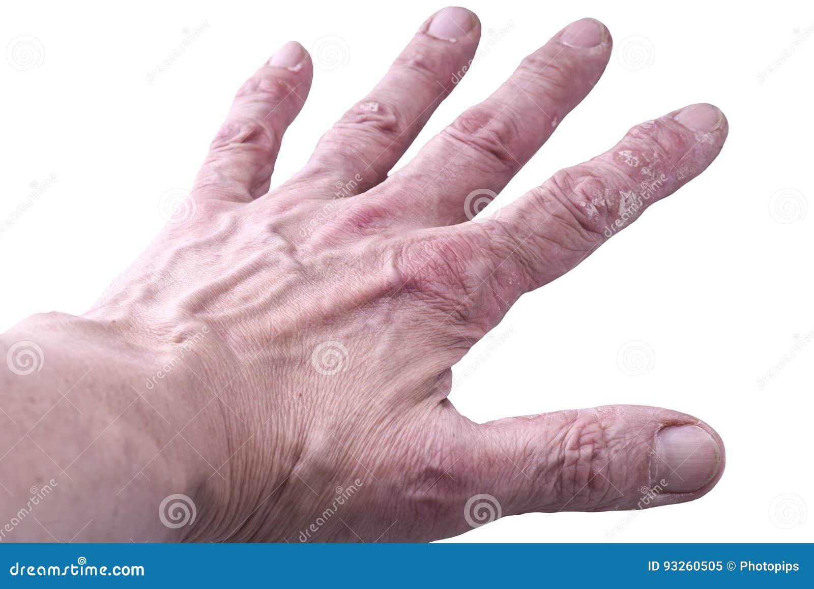 Psoriasi, Malattia Della Pelle Immagine Stock - Immagine di barrette ...