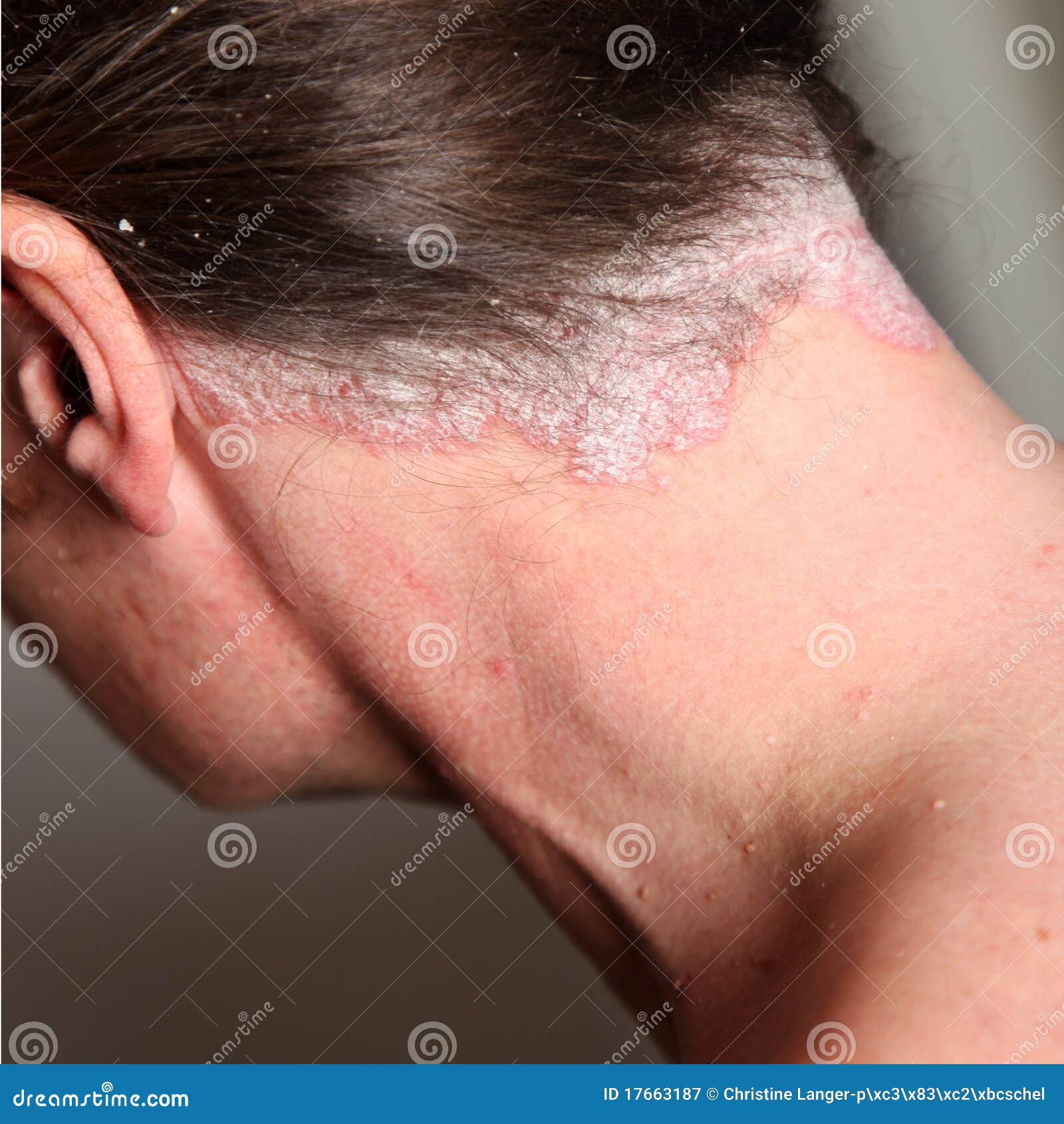 Psoriasi severa - collo immagine stock. Immagine di psoriasi - 17663187