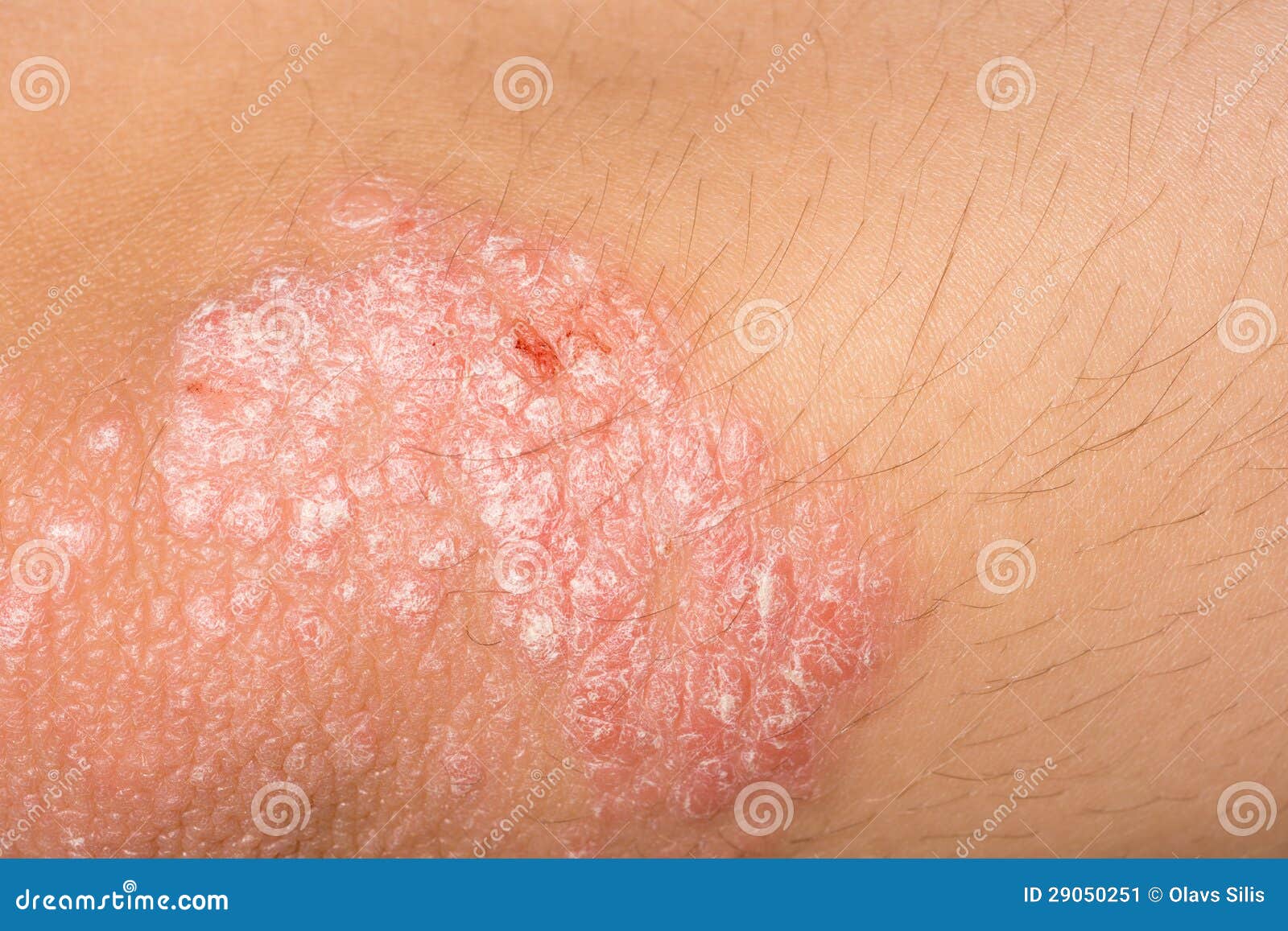 Psoriasis stock image. Image of auto, cycle, healthcare - 29050251