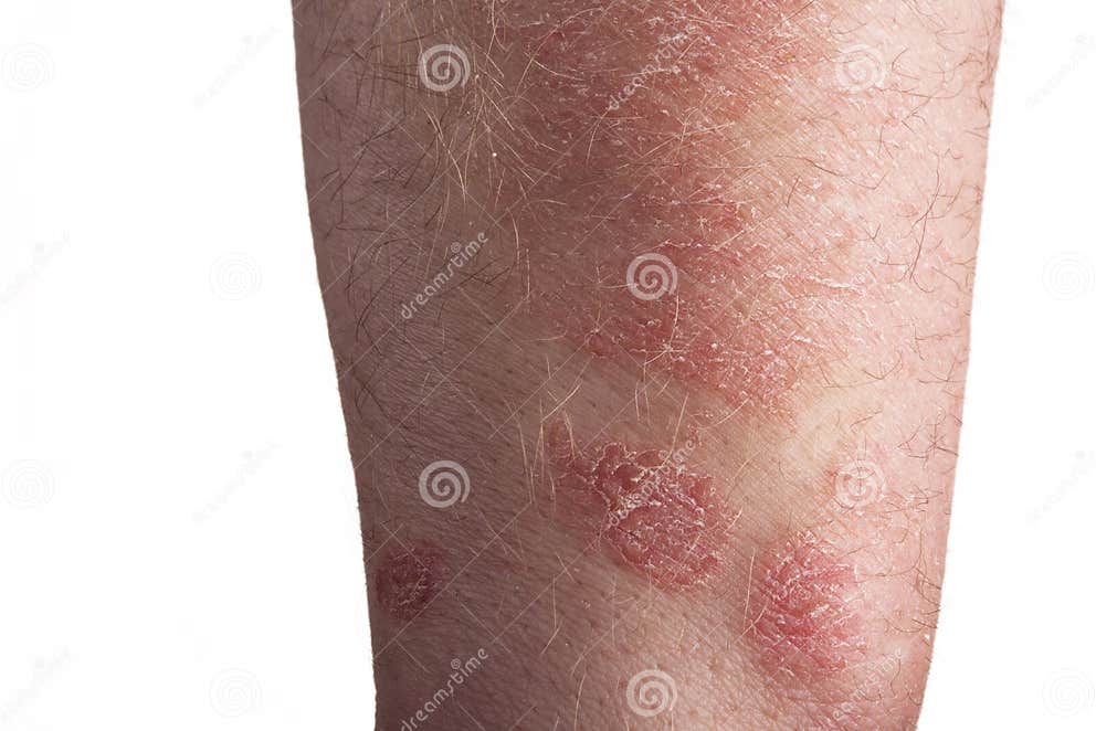Psoriasis on the arm stock image. Image of medical, ugliness - 23055537