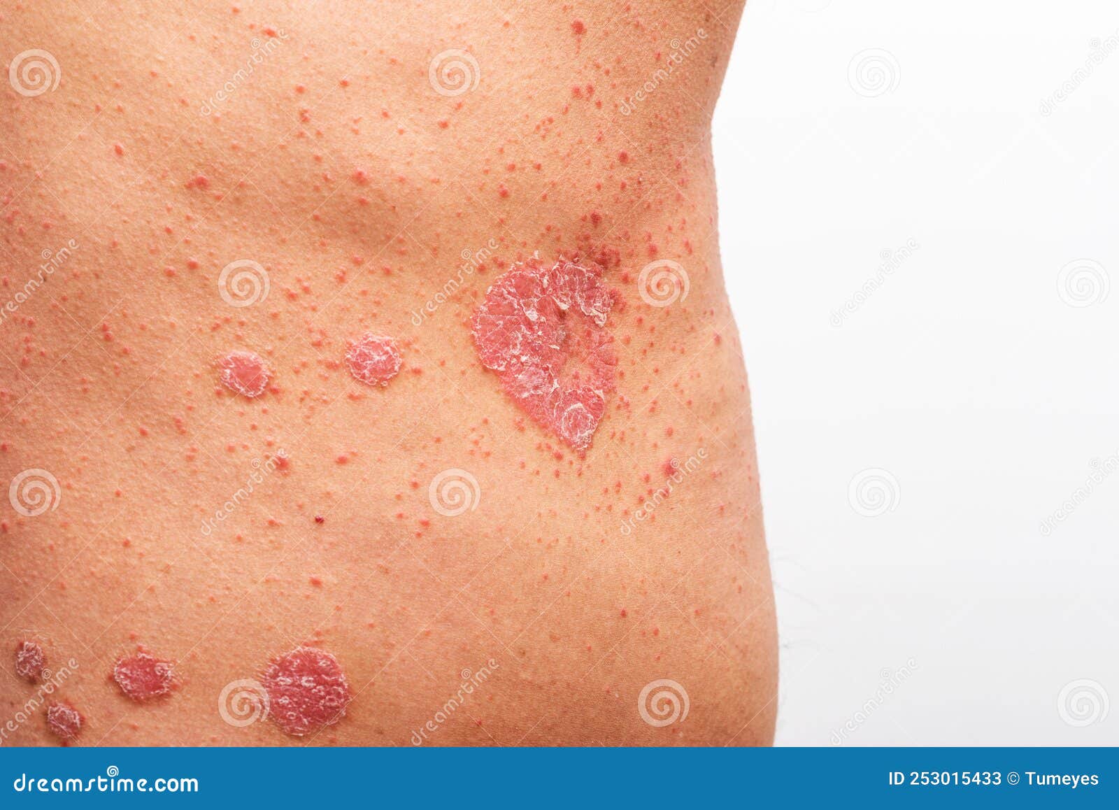 Psoriasis is that Back on White Background Stock Image - Image of ...