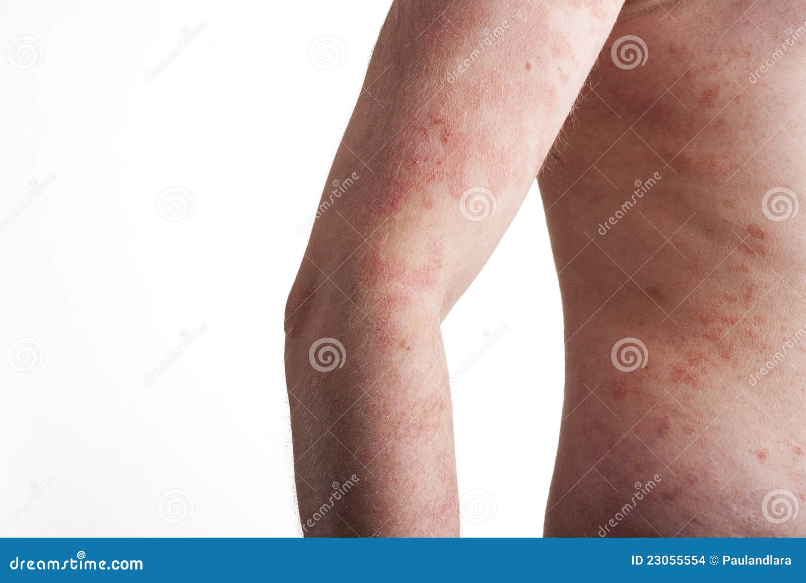 Psoriasis on the body stock photo. Image of irritation - 23055554