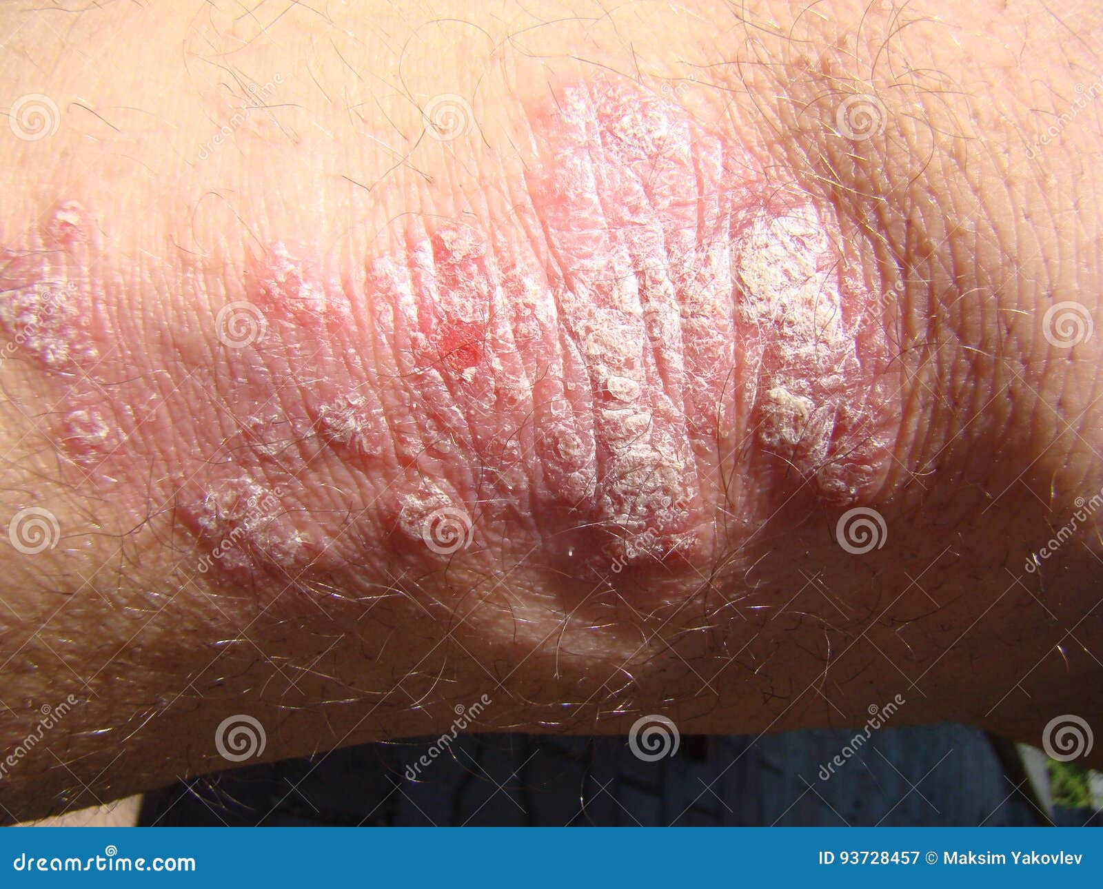 Psoriasis stock image. Image of lymphocytes, plaque, papules - 93728457