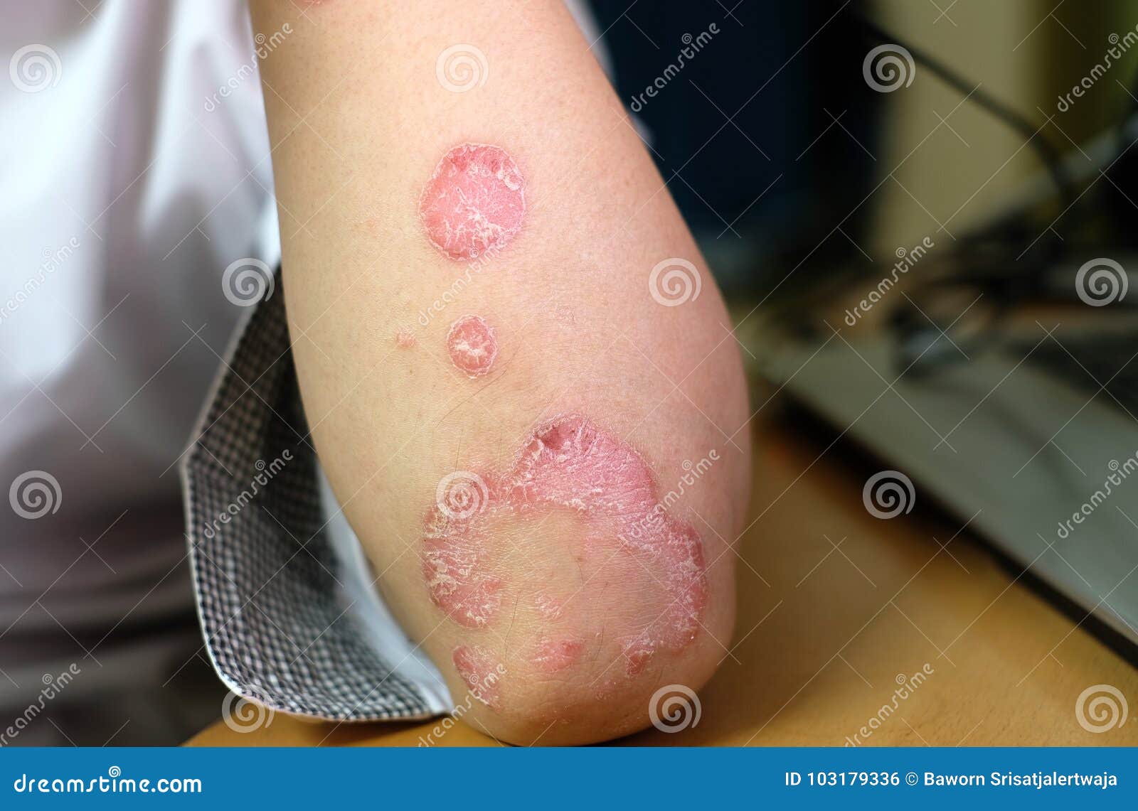 Psoriasis stock photo. Image of medical, human, scales - 103179336