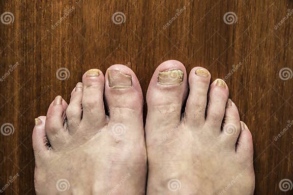 Psoriasis dans le pied photo stock. Image du très, dermatite - 129728100