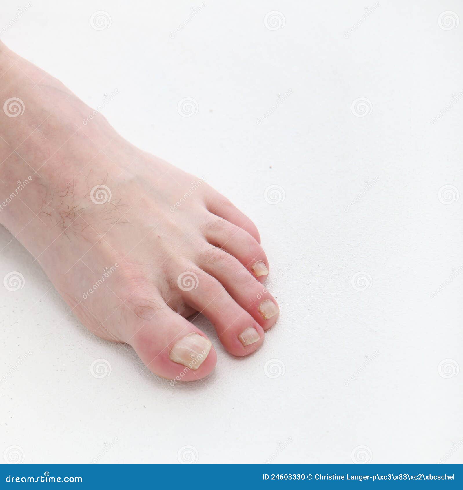 Psoriasis Der Zehennägel Mit Textplatz Stockfoto - Bild von behandlung ...