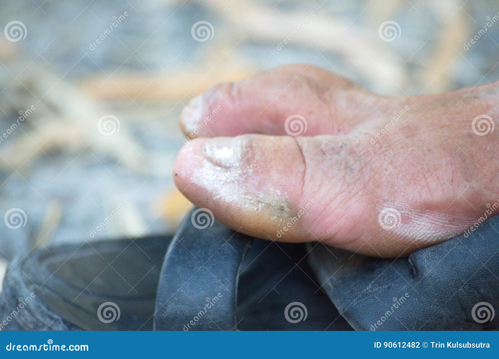 Psoriasis, Dermatitis Callosidad Del Pie Foto de archivo - Imagen de ...