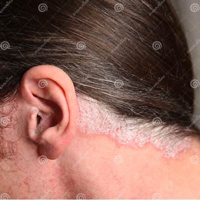 Psoriasis in the Ear and Neck Stock Image - Image of finger, relief ...