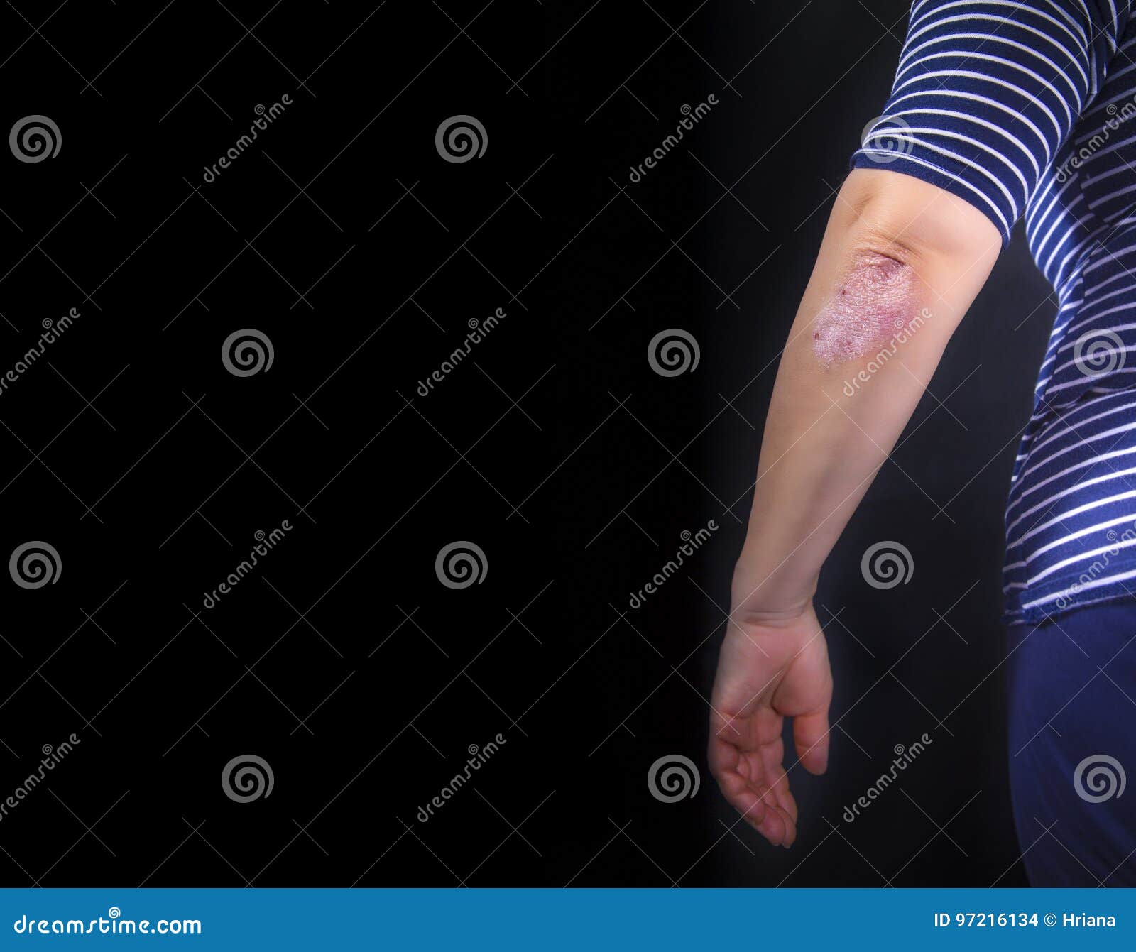 Elbow Dark Spots. Spots And Freckles Royalty-Free Stock Photography ...