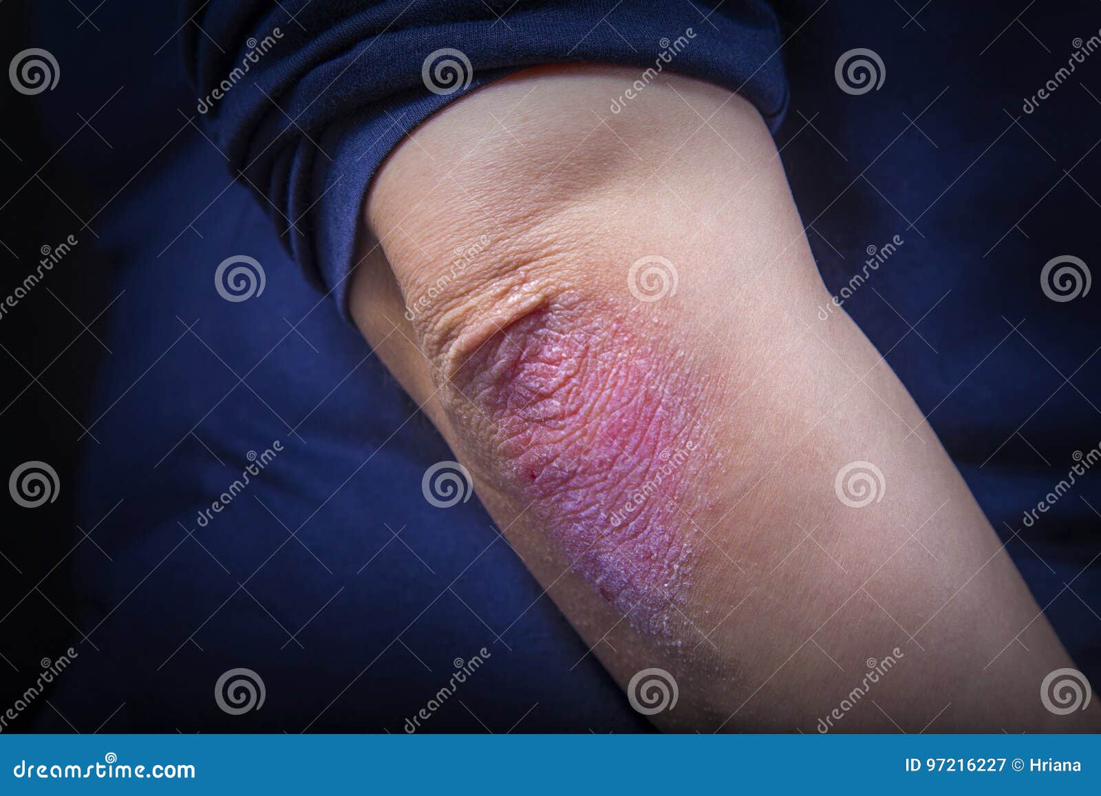Psoriasis On The Elbow. Closeup Dermatitis On Skin Ill Allergic Rash ...