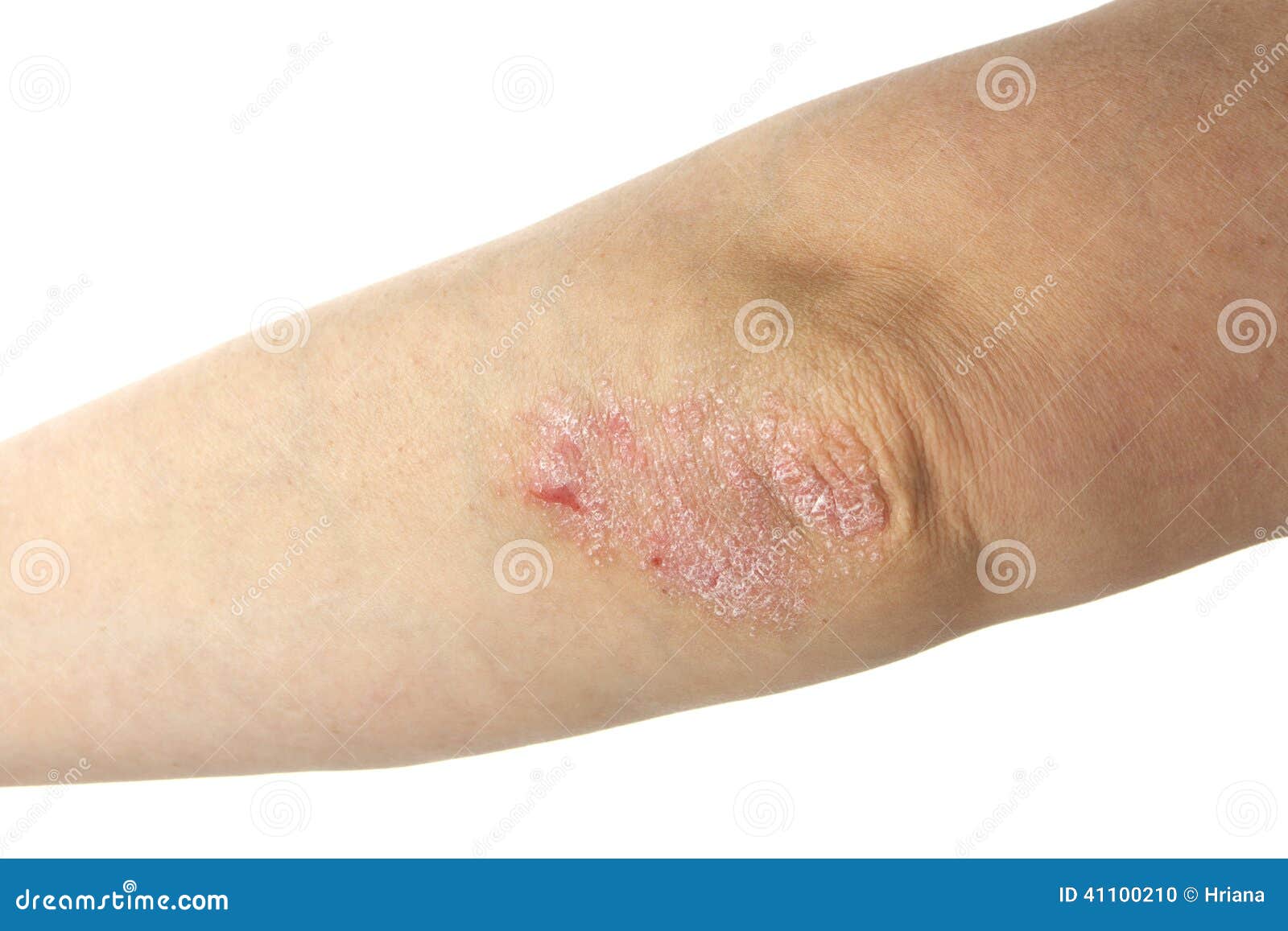 Psoriasis stock photo. Image of itchy, dermatitis, care - 41100210