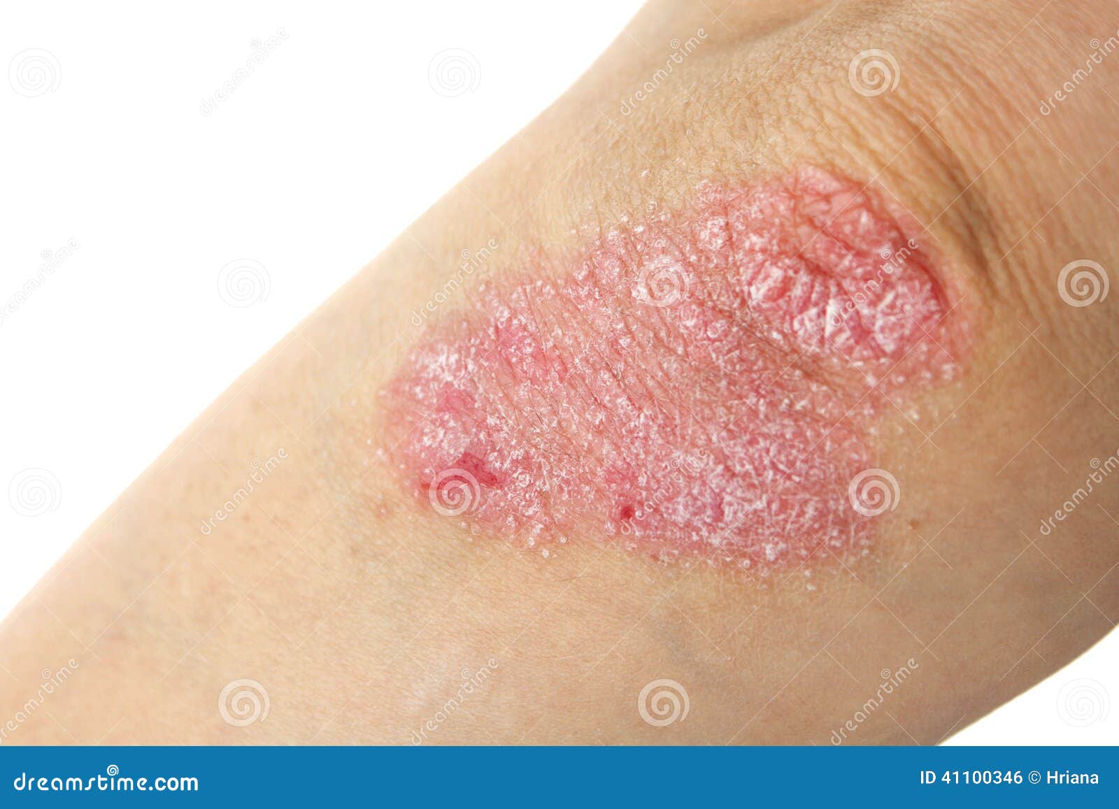 Psoriasis Eczema On The Hand Man Itching Skin Psoriasis Scales Are ...