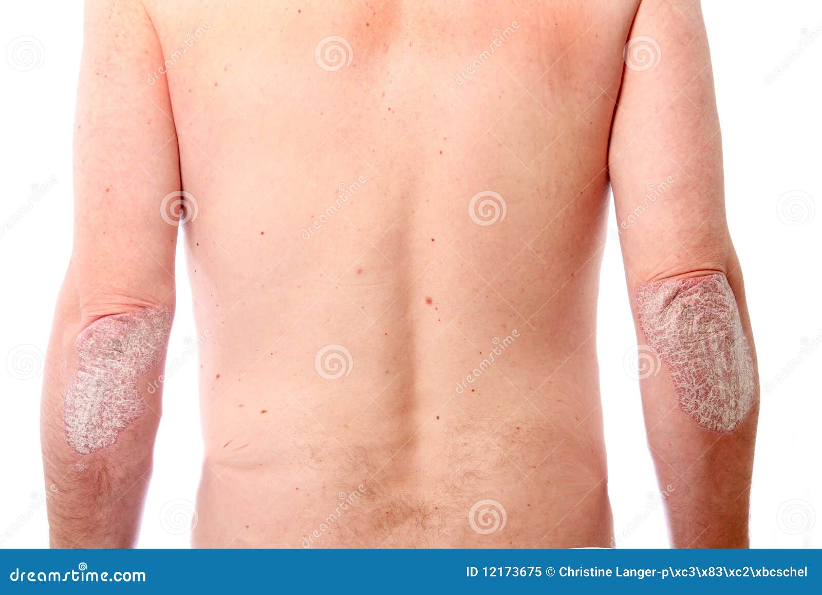 Psoriasis en ambos codos imagen de archivo. Imagen de médico - 12173675