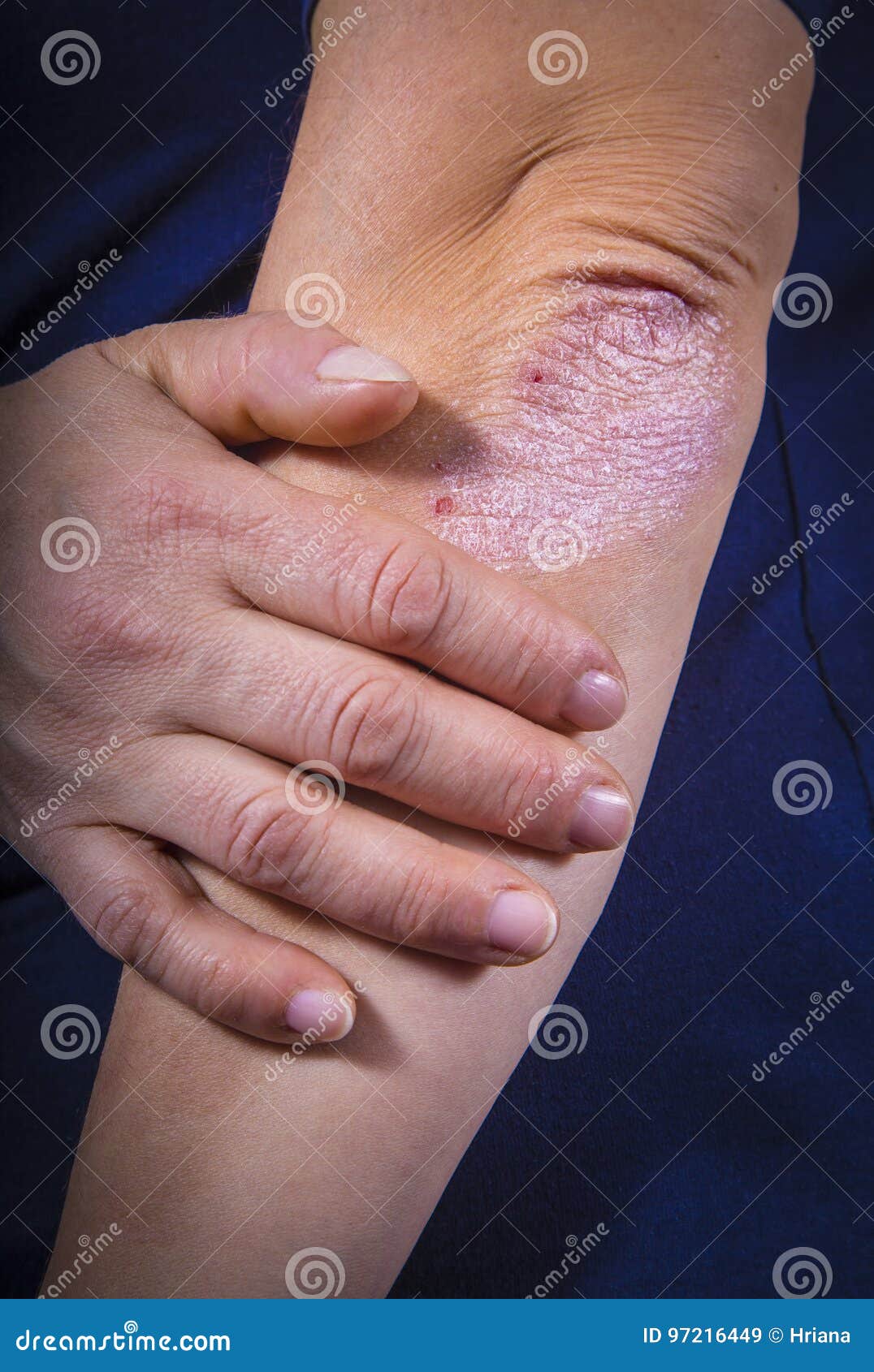 Psoriasis en codo imagen de archivo. Imagen de dermatitis - 97216449