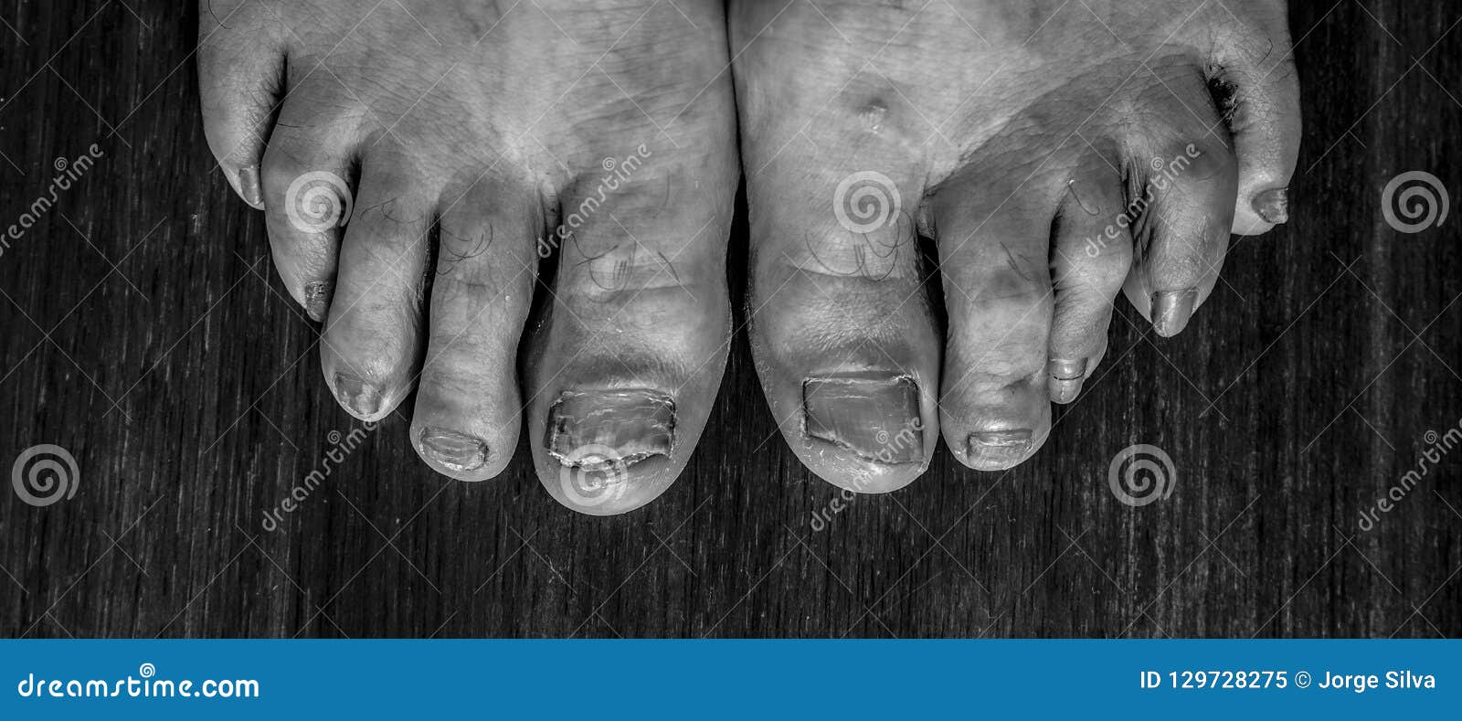 Psoriasis en el pie imagen de archivo. Imagen de salud - 129728275