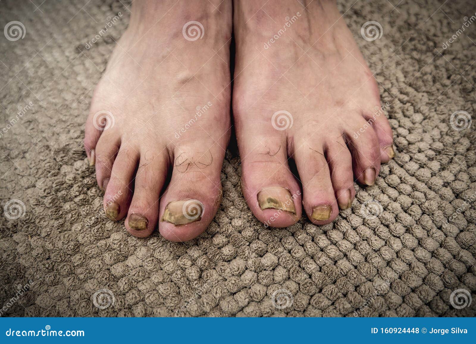 Psoriasis en el pie foto de archivo. Imagen de paciente - 160924448