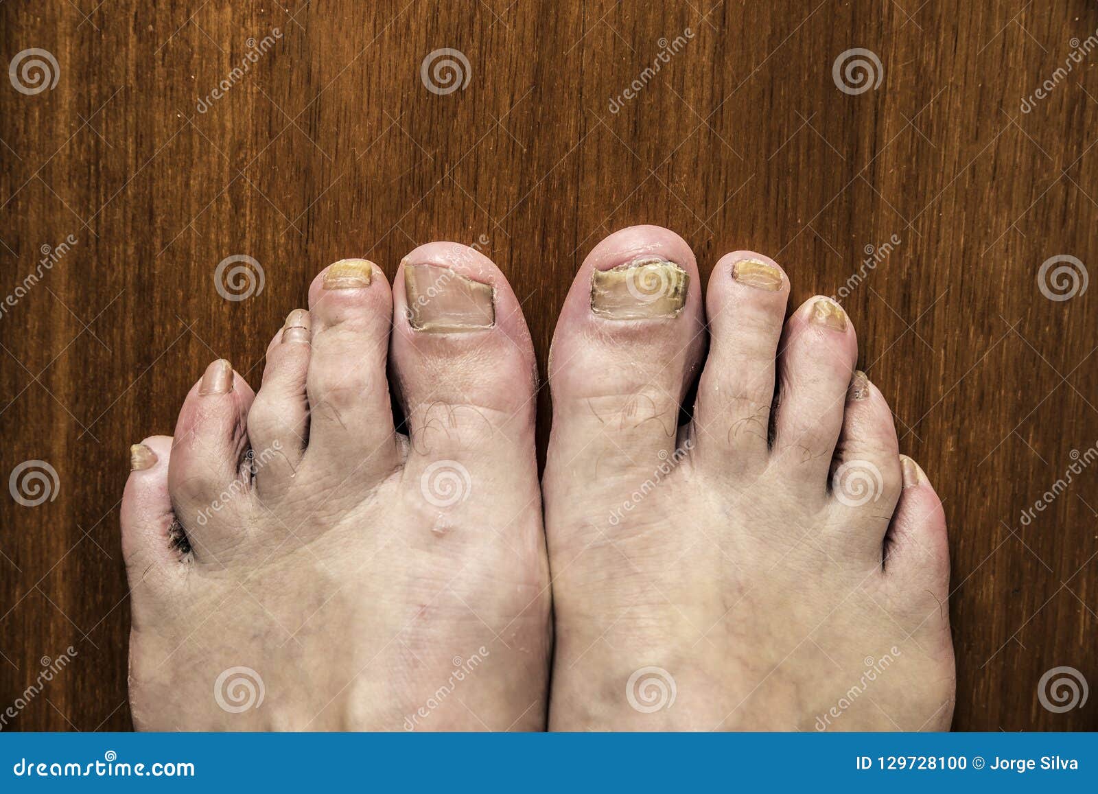 Psoriasis in the foot stock photo. Image of ugly, dermatitis - 129728100