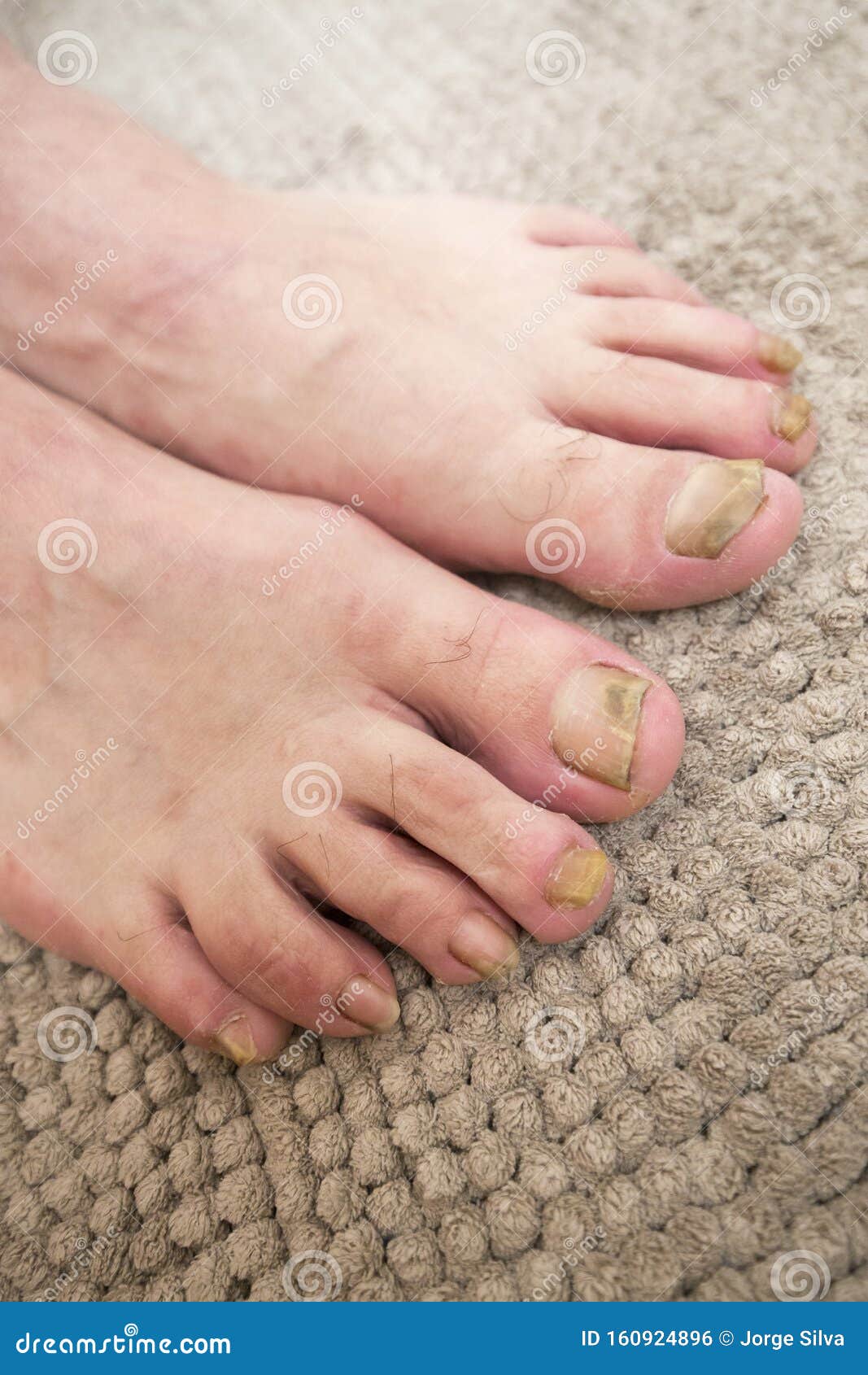 Psoriasis in the foot stock photo. Image of closeup - 160924896