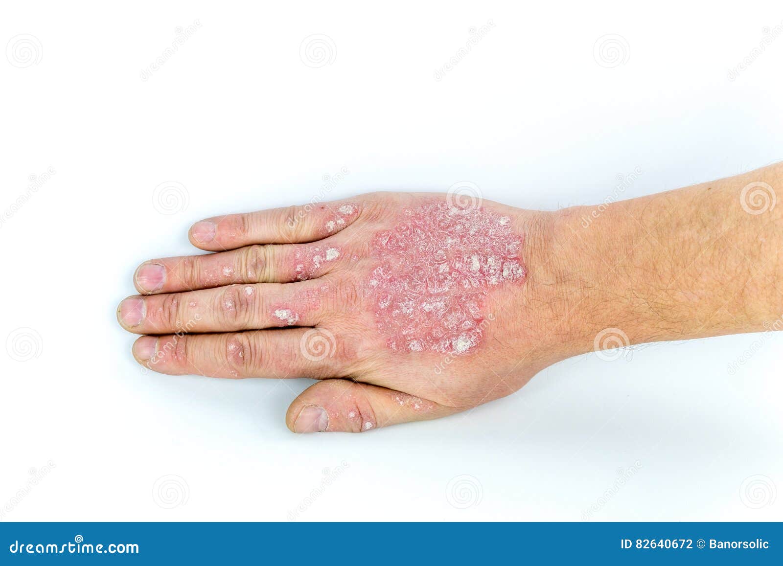 Psoriasis on the Hand on White Stock Photo - Image of care, allergic ...