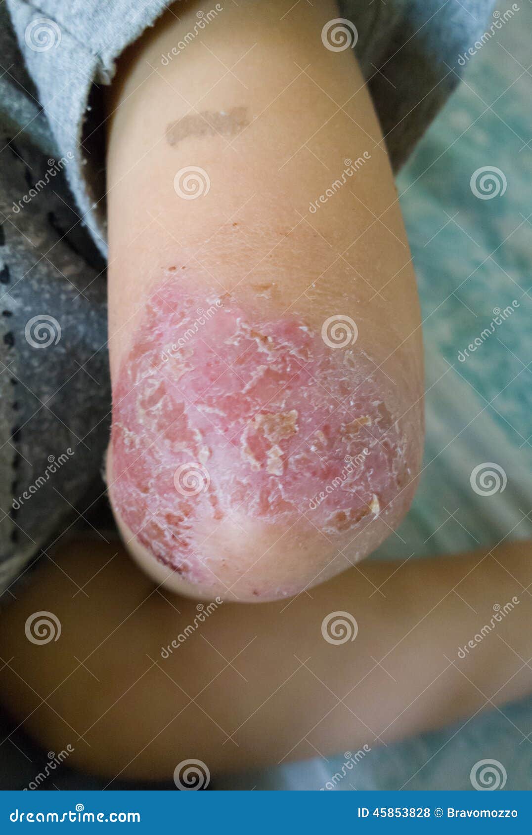 Psoriasis On The Elbow. Closeup Dermatitis On Skin Ill Allergic Rash ...
