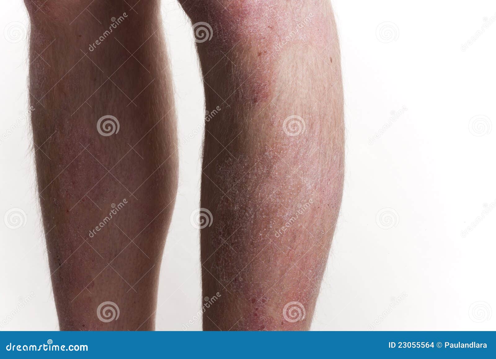 Psoriasis Legs
