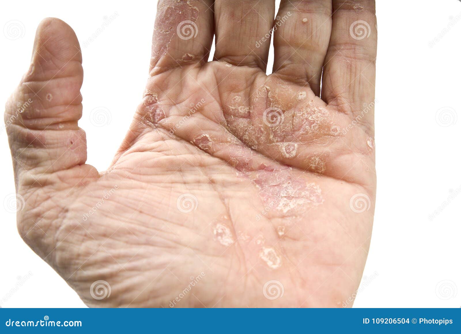 Psoriasis, Maladie De La Peau Photo stock - Image du masculin, crème ...
