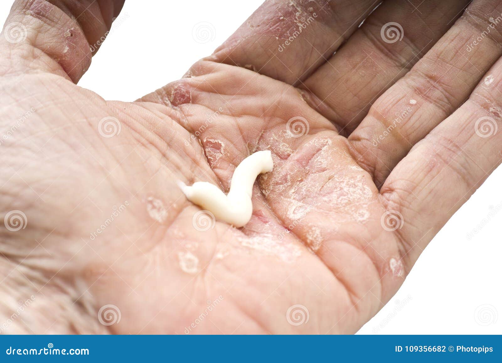 Psoriasis, Maladie De La Peau Photo stock - Image du fermer ...