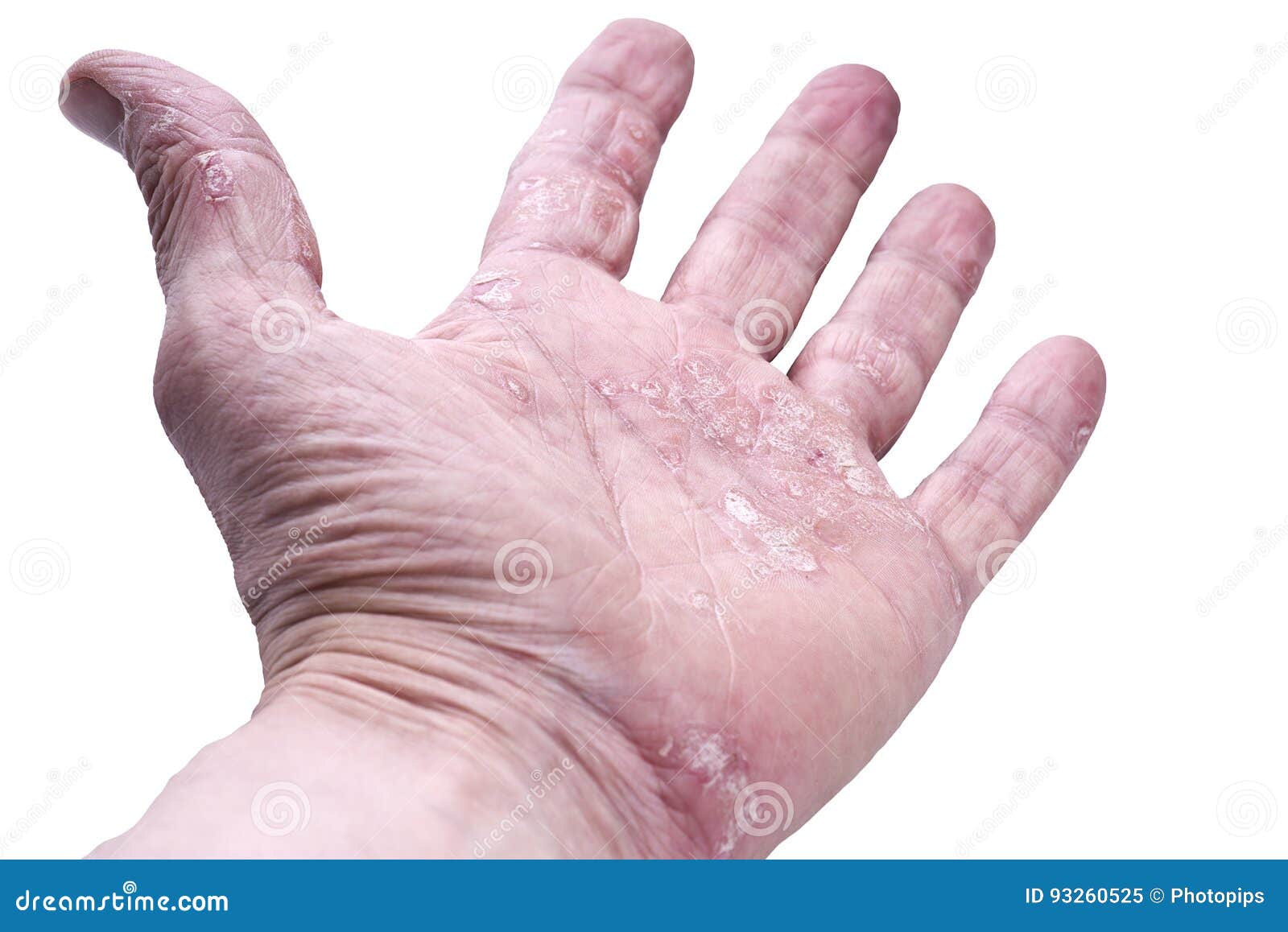 Psoriasis, Maladie De La Peau Image stock - Image du humain ...