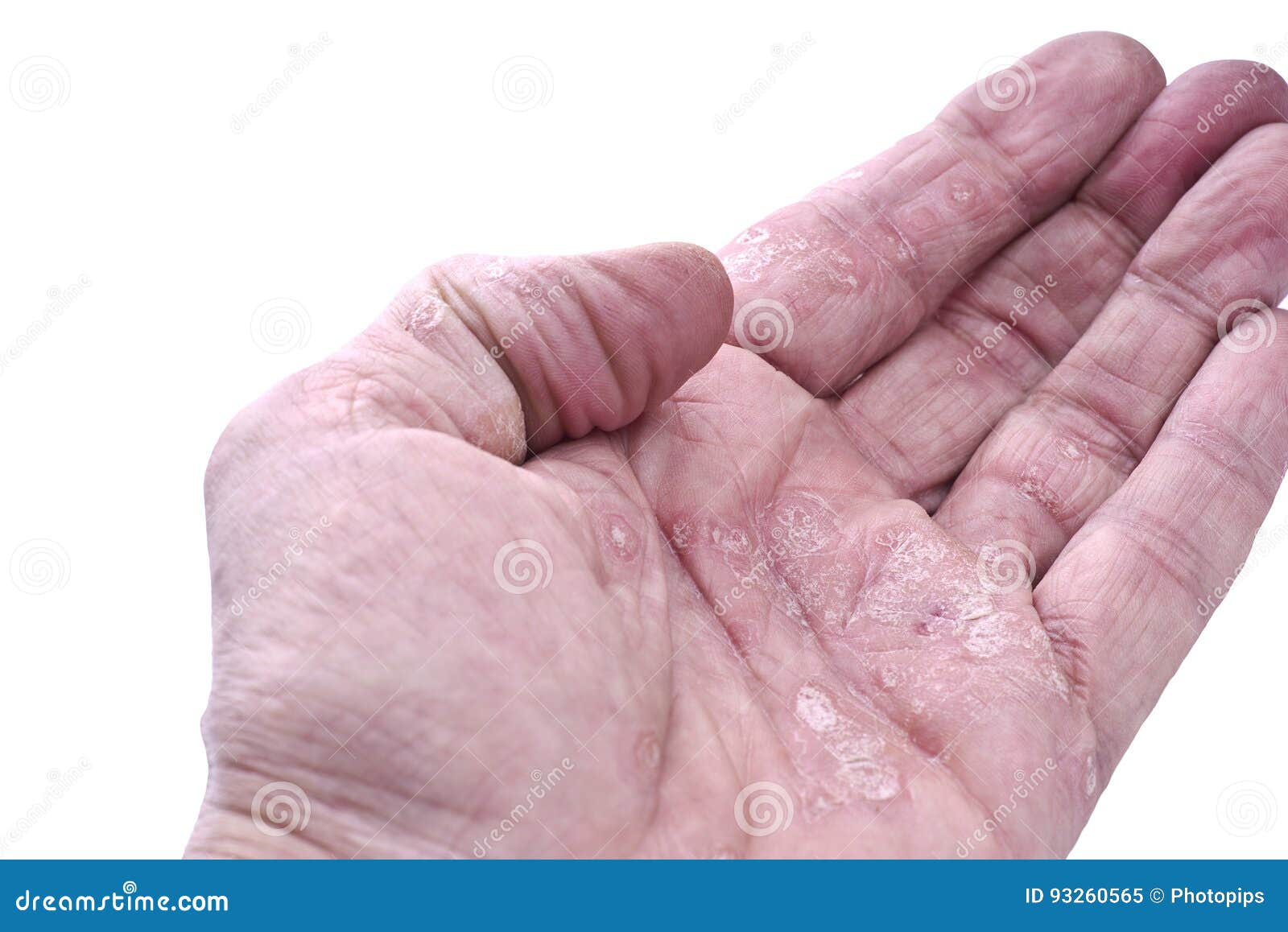 Psoriasis, Maladie De La Peau Image stock - Image du paume, pied: 93260565