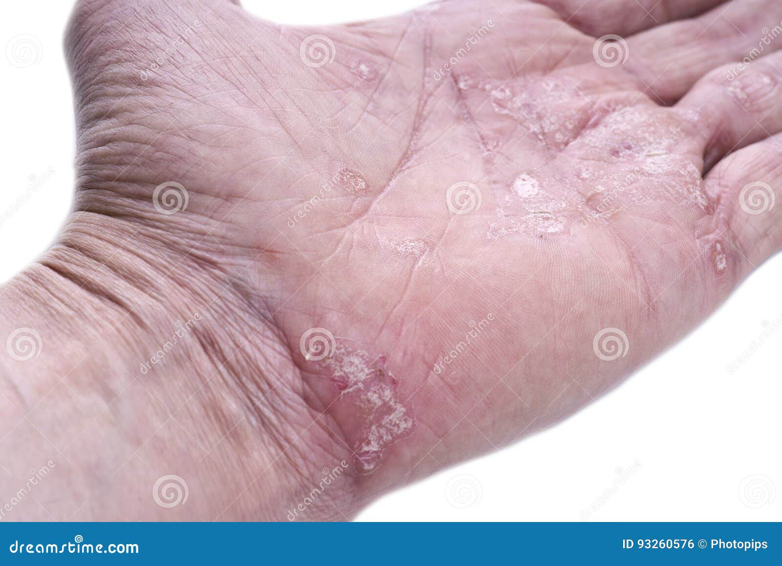 Psoriasis, Maladie De La Peau Photo stock - Image du paume, humain ...
