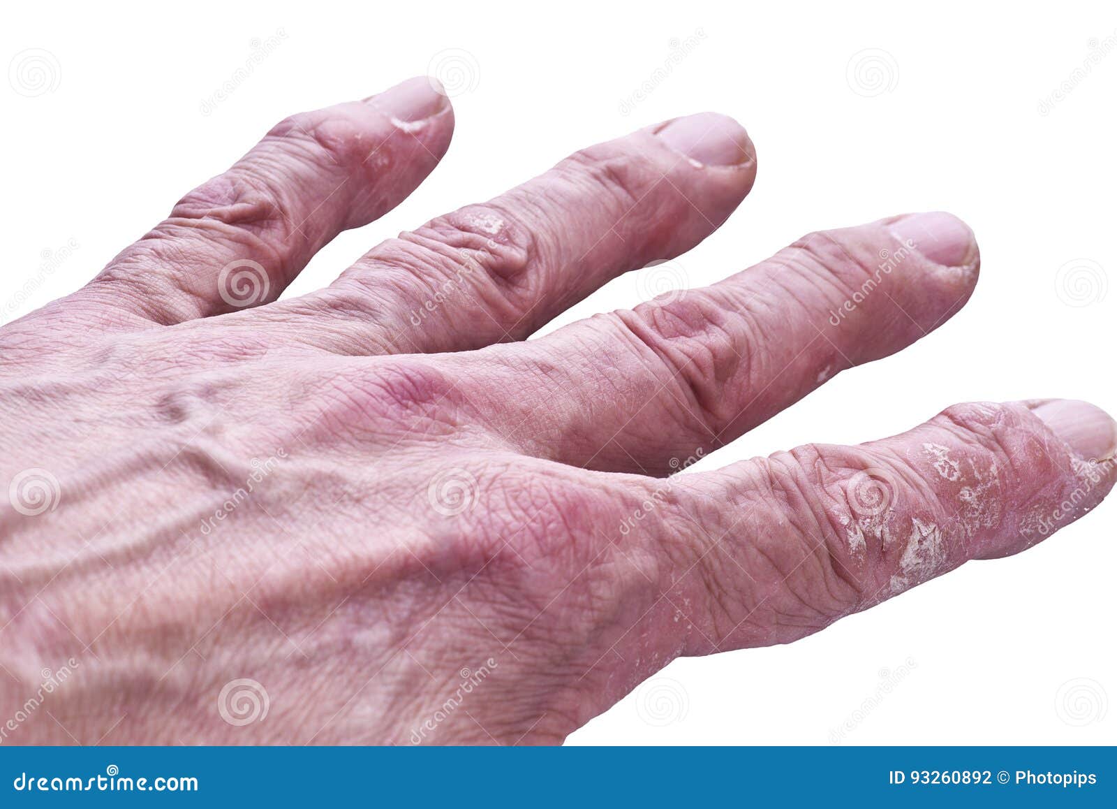 Psoriasis, Maladie De La Peau Photo stock - Image du santé, désordre ...