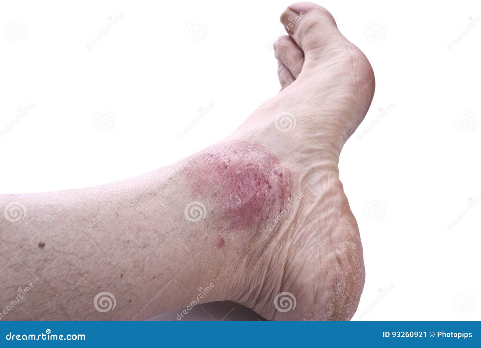 Psoriasis, Maladie De La Peau Image stock - Image du fermer, infection ...