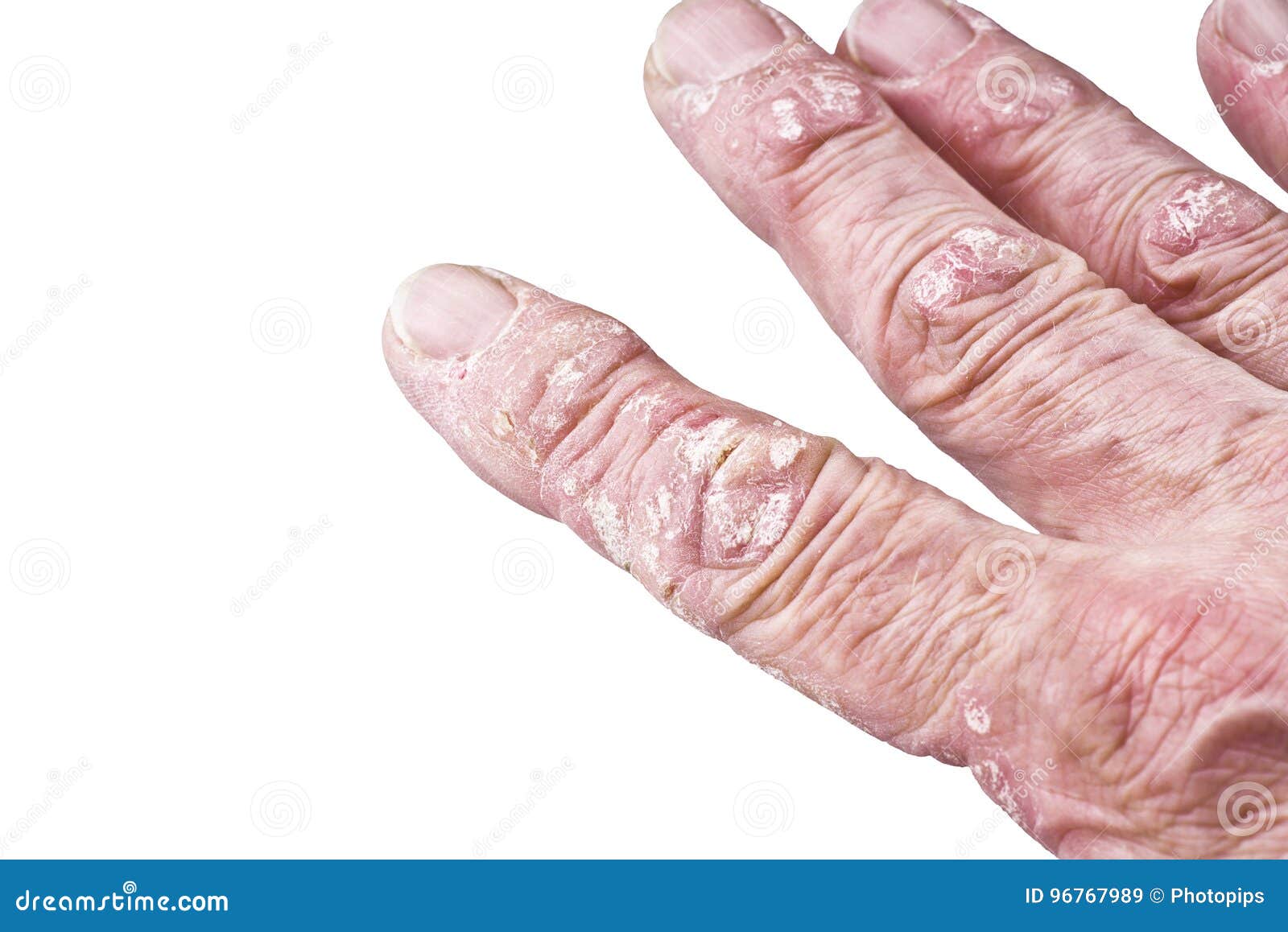 Psoriasis, Maladie De La Peau Image stock - Image du piquage, tête ...